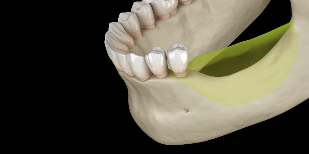 Tooth and Bone Loss - Sparacino Periodontics