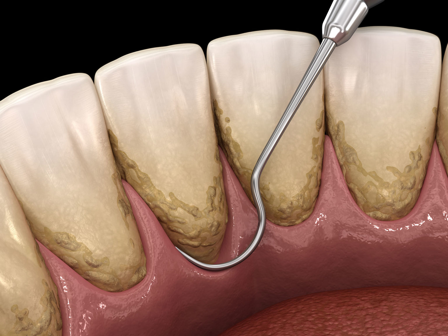 Periodontal Maintenance - Sparacino Periodontics