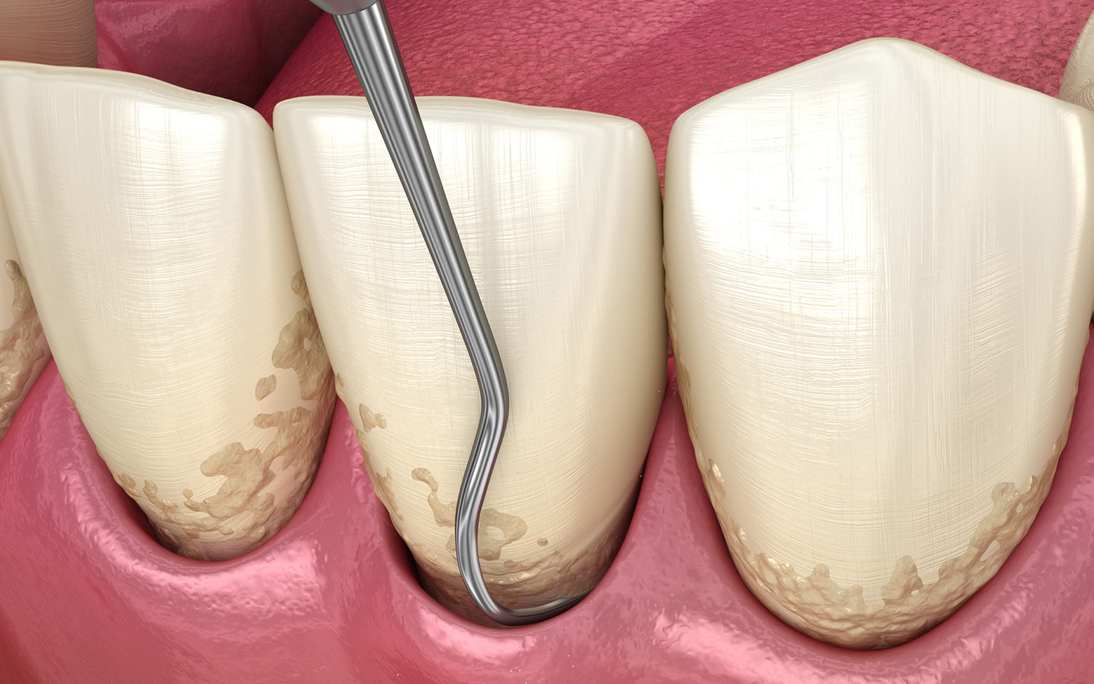 Scaling and Root Planing - Sparacino Periodontics Scaling and Root Planing - Sparacino Periodontics